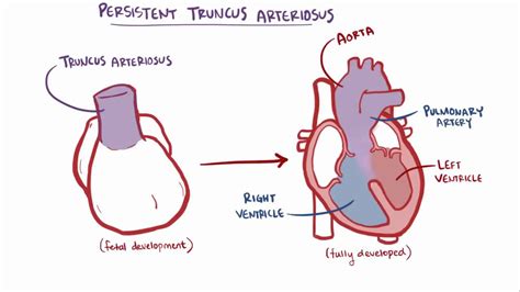 Truncus Arteriosus