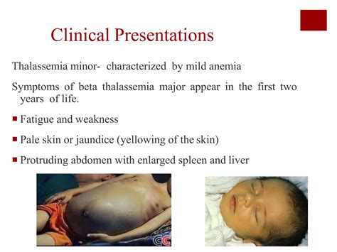 Thalassemia Pptx