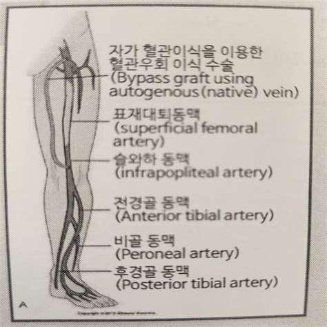 [심혈관계]동맥경화협착 검사