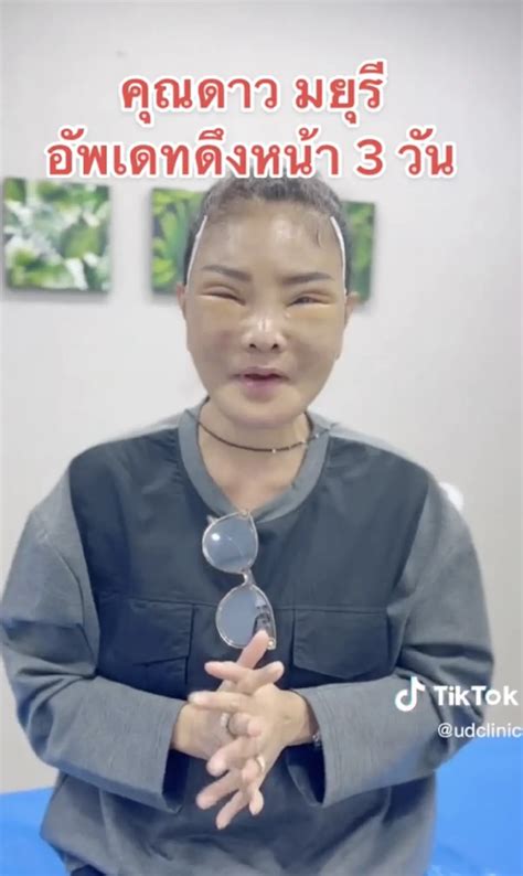 เปิดหน้าใหม่ ดาว มยุรี หลังทำศัลยกรรมครบ 14 วัน เริ่มสวยเป๊ะปังเข้าที่แล้ว ไทยนิวส์