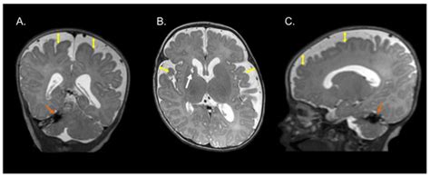 Brain Sciences Free Full Text Prevention Of Neurological Sequelae In Preterm Infants