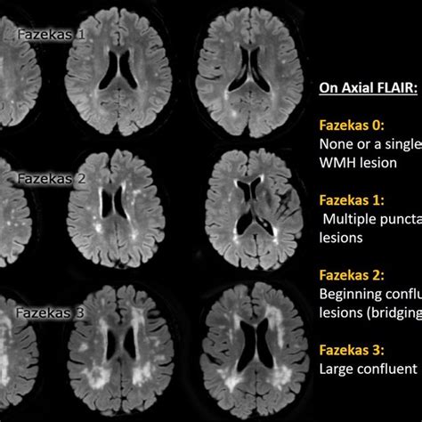 Diffuse Brain Atrophy In A Hypertensive Patient Axial T2WI Shows Download Scientific Diagram