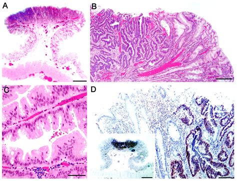 Colorectal Carcinomas Arising In The Hyperplastic Polyposis Syndrome