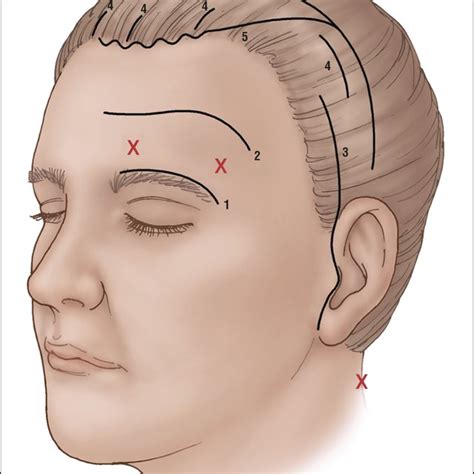 Brow Lifting Incisions 1 Direct 2 Midforehead 3 Temporal Cheek