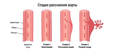 Расслаивающая аневризма аорты