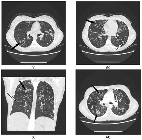 Nontuberculous Mycobacterial Lung Disease In The Patients With Cystic