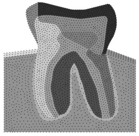 Polymers Free Full Text Elasto Static Analysis Of Composite Restorations In A Molar Tooth A