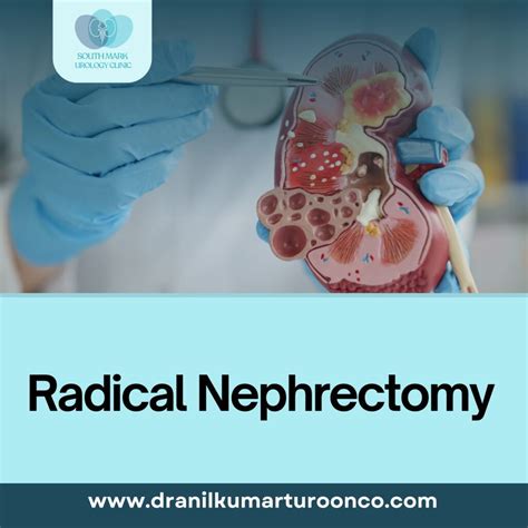 Best Radical Nephrectomy Treatment In India