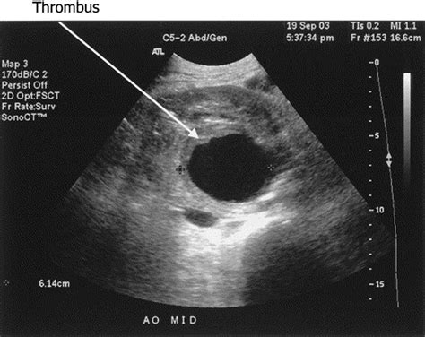 Abdominal Aortic Aneurysm Causes Symptoms Diagnosis And Treatment