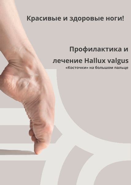 Болит нога Косточка на большом пальце Не игнорируйте дискомфорт 禮 Вальгусная деформация