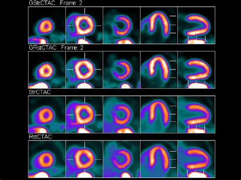 Cardiac Cartesion Prime Clinical Gallery Molecular Imaging Canon Medical Systems Usa