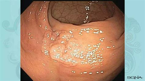 Kudos To You Learning Your Kudo Pit Patterns And Paris Polyp Classifications Pptx