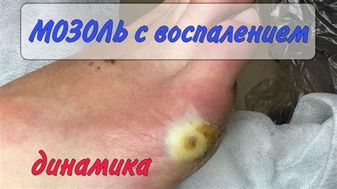 Мозоль воспалилась / мозоль на ноге / пластырь салипод - YouTube