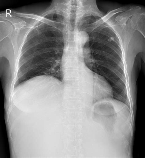 Cxr Lesion Detection Test Computer Vision Dataset By Krid Sumangsri