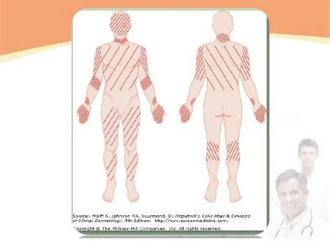 Atopic Dermatitis Immunology Pptx
