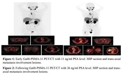 Ga 68 Psma 11 Pet In Progressive Prostate Cancer International