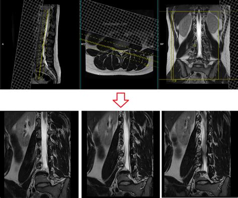 Lumbar Spine Exit Forearm View Mri Lumbar Spine Exit Forearm View