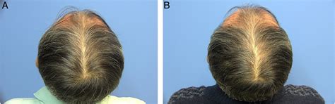 Subcutaneous Versus Combined Subcutaneous And Intramuscular Botulinum Toxin For Androgenetic
