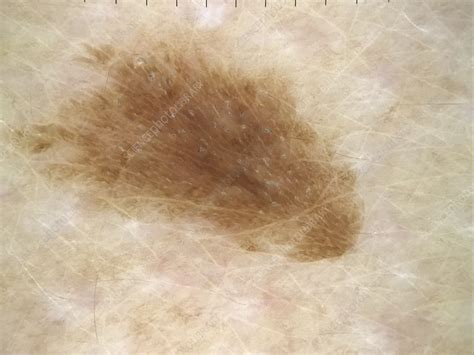 Seborrheic Keratosis Dermoscopy Stock Image C056 3231 Science Photo Library