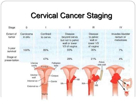 Premalignant And Malignant Conditions Of The Cervix Pptx Cancer
