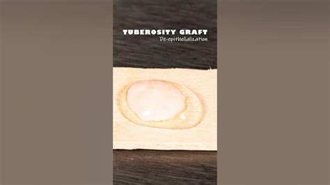 Tuberosity Tissue Graft De Epithelialization Youtube