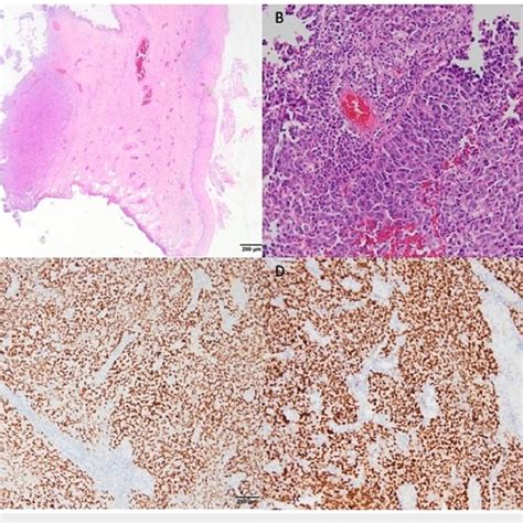 A A Tumor Nodule Is Seen Under The Squamous Epithelium In The Cervical Download Scientific