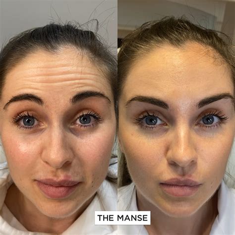 Forehead Wrinkles Treatment Expert Injecting Doctors At Sydney Clinic
