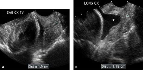 Dilated Cervix Ultrasound