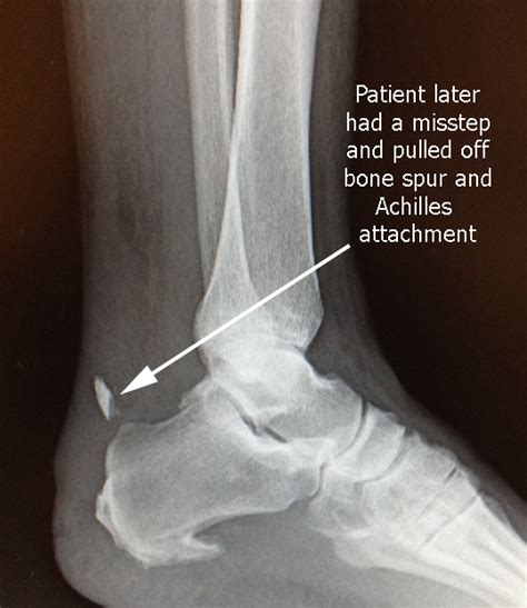 Achilles Spur Treatment