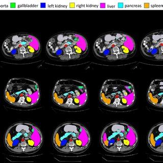 Visualization Of Segmentation Results On The Synapse Dataset Our Download Scientific Diagram