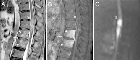 Intramedullary Spinal Cord Abscess And Subsequent Granuloma Formation