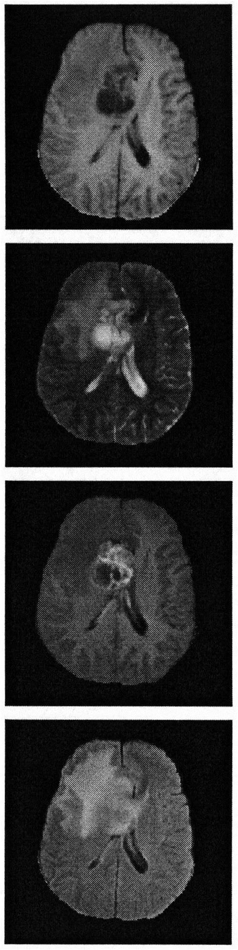 基于3du Net的轻量级脑肿瘤分割系统
