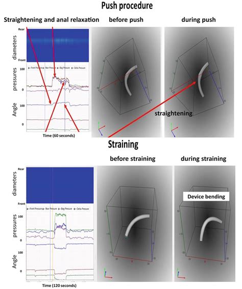 Top Correctly Done Push Procedure With Anal Relaxation And Device Download Scientific Diagram