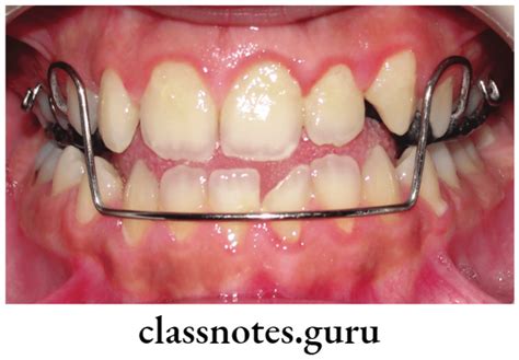 Removable Orthodontic Appliance Question And Answers Class Notes