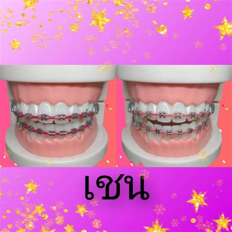 สินค้าแฟชั่น พร้อมส่งแบบเชน รีเทนเนอร์ไร้เหงือก Dragon29shop Thaipick