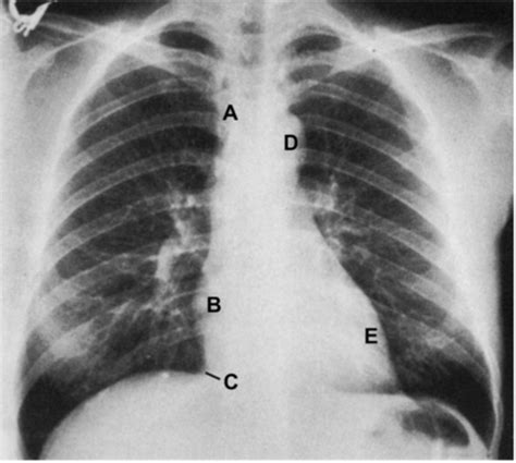 Chest Radiology Flashcards Quizlet
