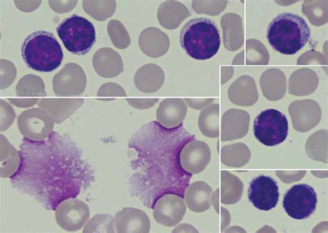 Chronic Active Epstein Barr Virus Infection As The Basis Of Neoplasm