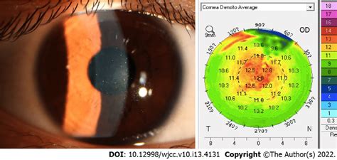 Slit Lamp Photograph Examination Of Grade 0 Diffuse Lamellar Keratitis