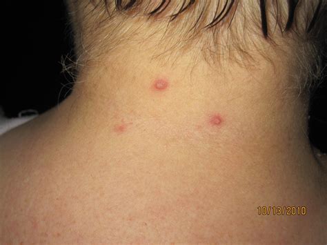 What Do Roach Bites Look Like A Comprehensive Guide For 2024