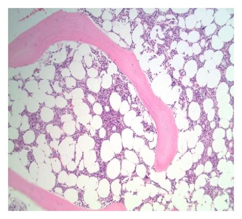 Bone Marrow Showing Hypocellularity And Trilineage Hematopoiesis Download Scientific Diagram