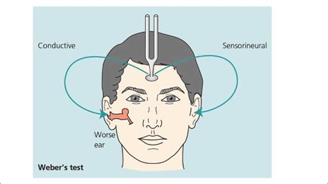 Tuning Fork Test Cinebezy