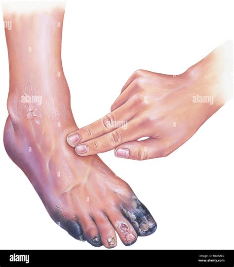 What Is Type 2 Diabetes Mellitus With Diabetic Peripheral Angiopathy