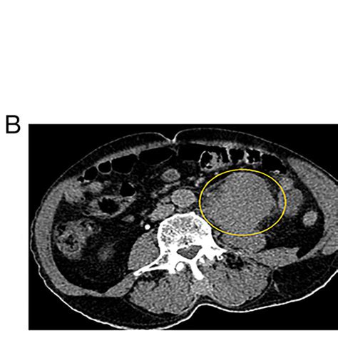 Contrast Ct Scan Of The Abdomen And Pelvis A Coronal And B Axial