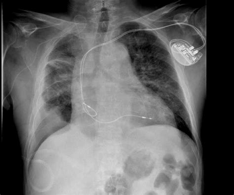 Chest Radiograph Of Case 1 Showing Right Pleural Thickening With Tipc Download Scientific