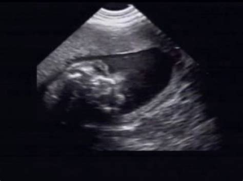 Macrocephaly Ultrasoundpaedia