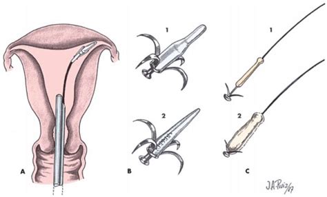 DA5C29FF25 Gif Abdominal Key