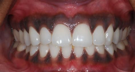 Black Gums And Spots On Gums Causes Treatment And Reasons