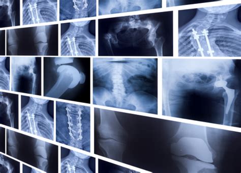 Difference Between X Ray And CT Scan 1 Difference Between