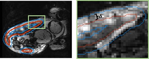Figure 1 From Shape Aware Segmentation Of The Placenta In Bold Fetal Mri Time Series Semantic