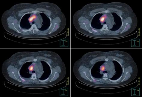 The Positron Emission Tomography Computed Tomography Shows